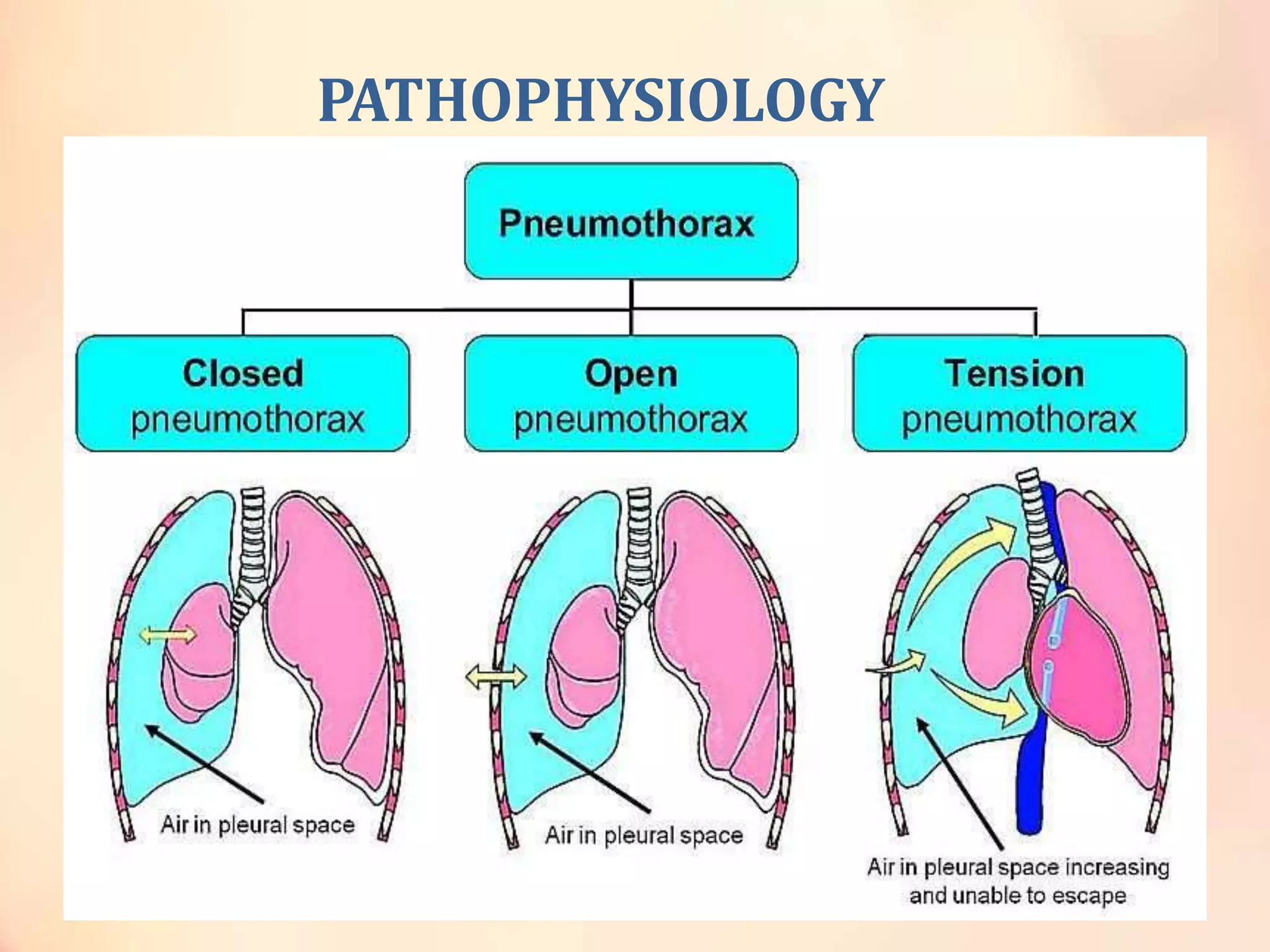 pneumothorax BY DR.P.MADHU HARSHA | PPTX | Lung and Respiratory Health ...