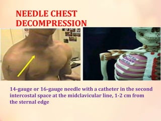pneumothorax BY DR.P.MADHU HARSHA | PPTX