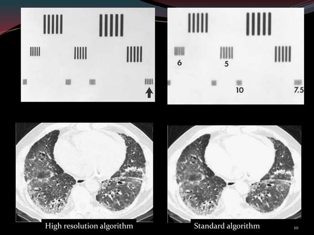 DR Harshil Radiology HRCT | PPT