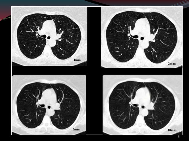DR Harshil Radiology HRCT | PPT