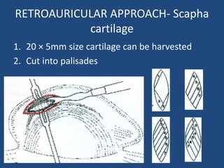 Harvesting cartilage for cartilage tympanoplasty | PPSX | Ear, Nose and ...
