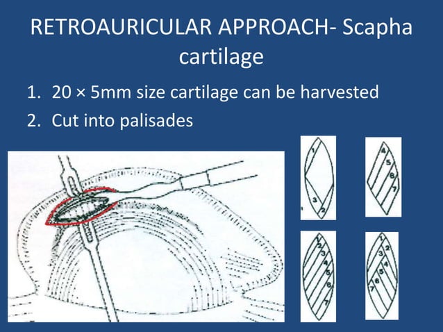 Harvesting cartilage for cartilage tympanoplasty | PPT