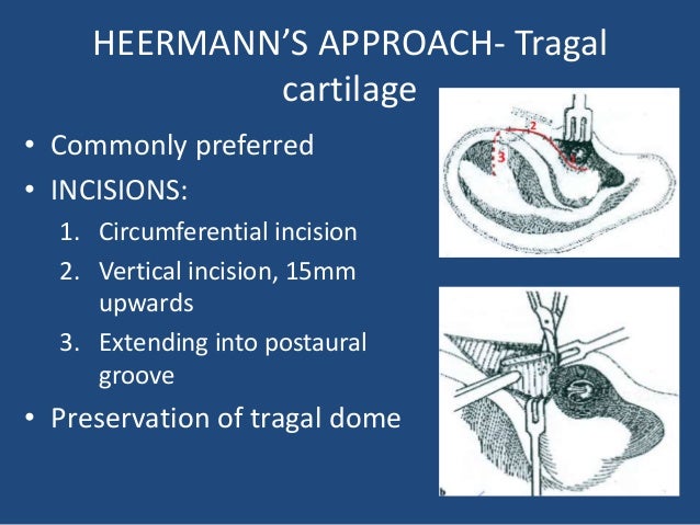 Harvesting cartilage for cartilage tympanoplasty