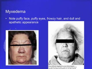 Hashimoto disease | PPTX