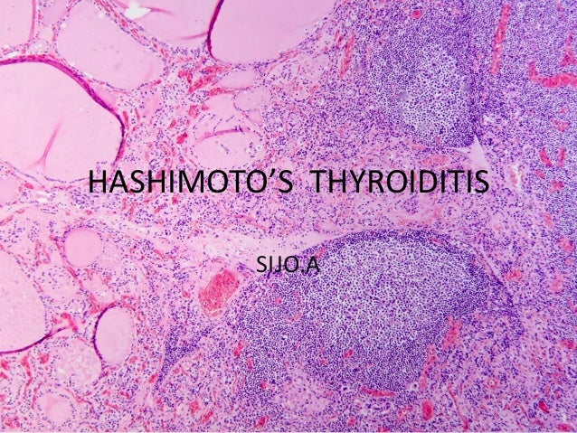Thyroiditis