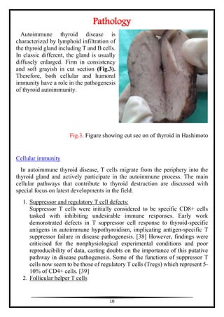 Hashimoto's thyroiditis 2018 | PDF