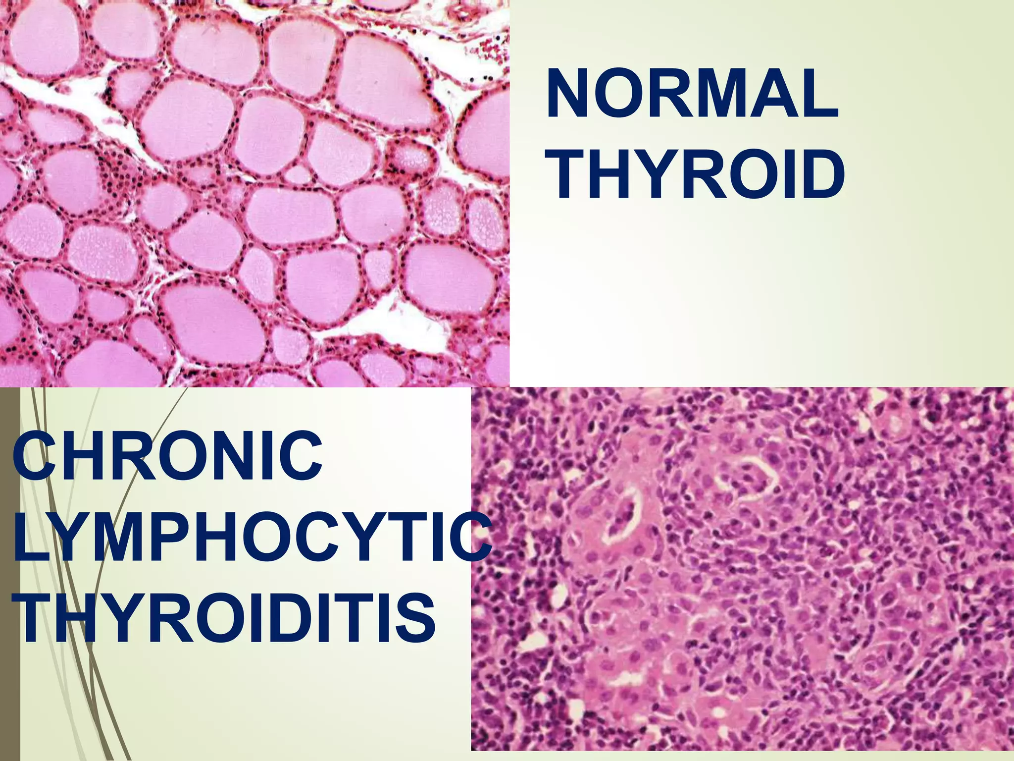 Hashimoto's thyroiditis by aslammatania | PPTX