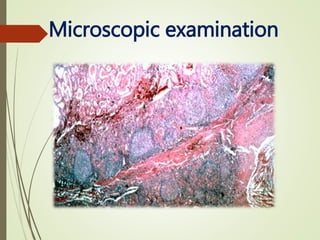 Hashimoto's thyroiditis by aslammatania | PPTX