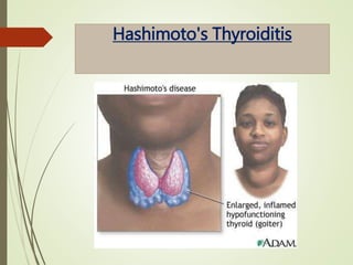 Hashimoto's thyroiditis by aslammatania | PPTX