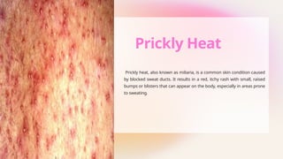 addressing dry skin, acne, sun protection,pigmentation, prickly heat ...