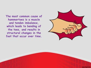 Have a hammertoe..? | PDF