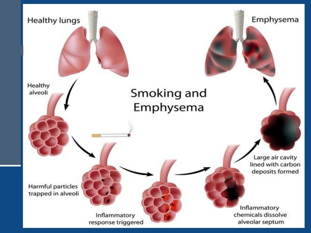 Effects of Tobacco on Health