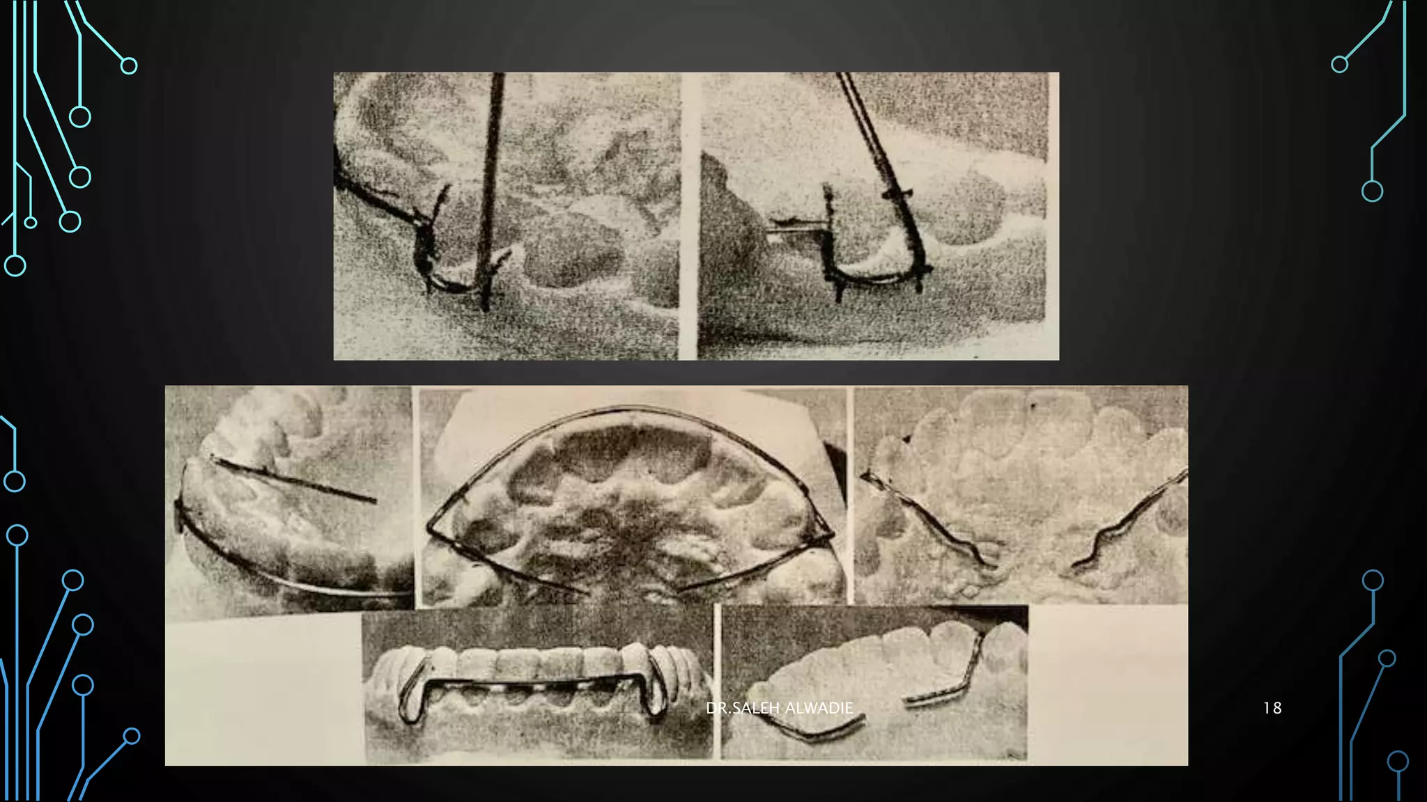 Hawley retainer | PPTX