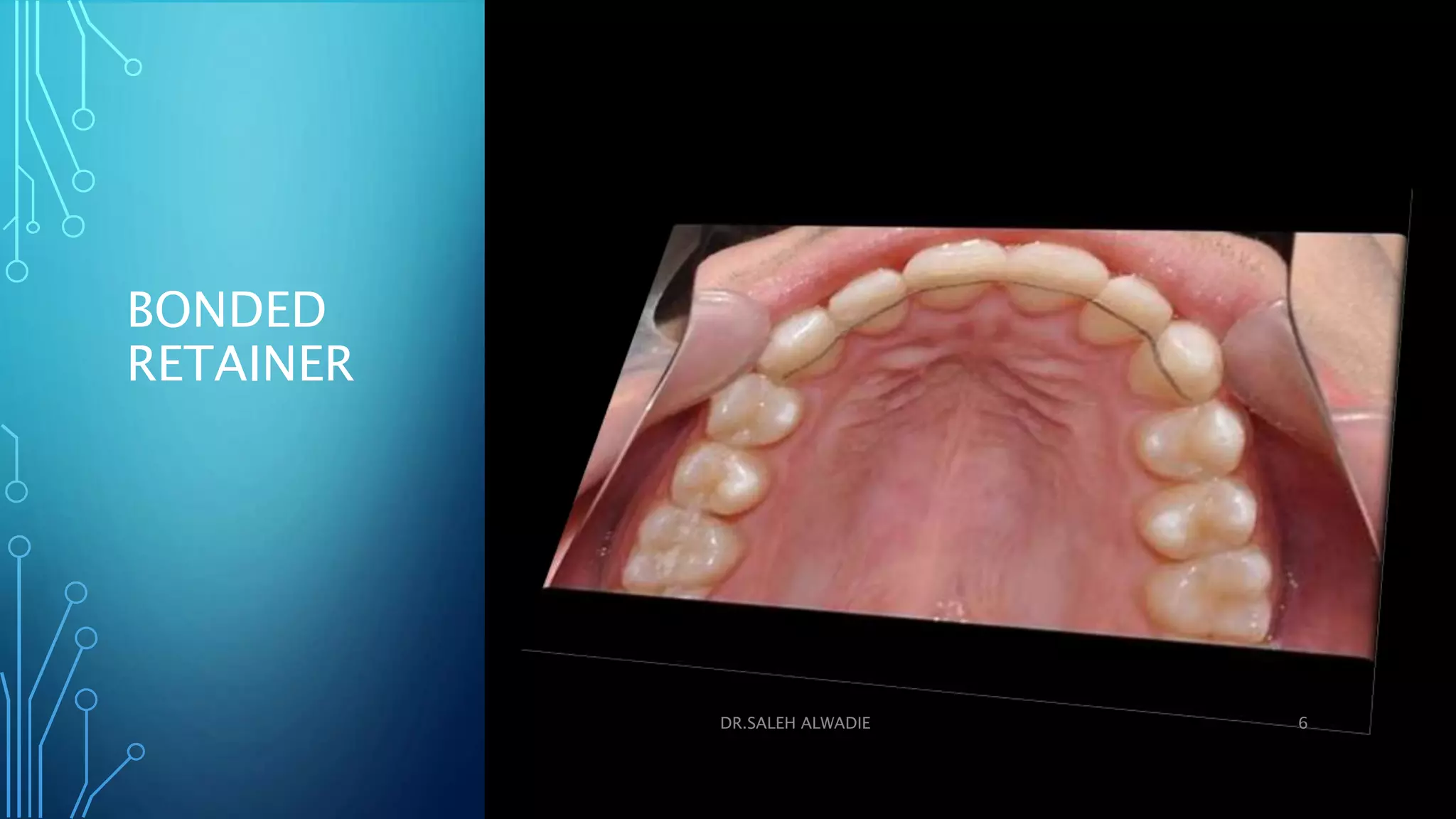 Hawley retainer | PPTX