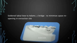 Hawley retainer | PPTX