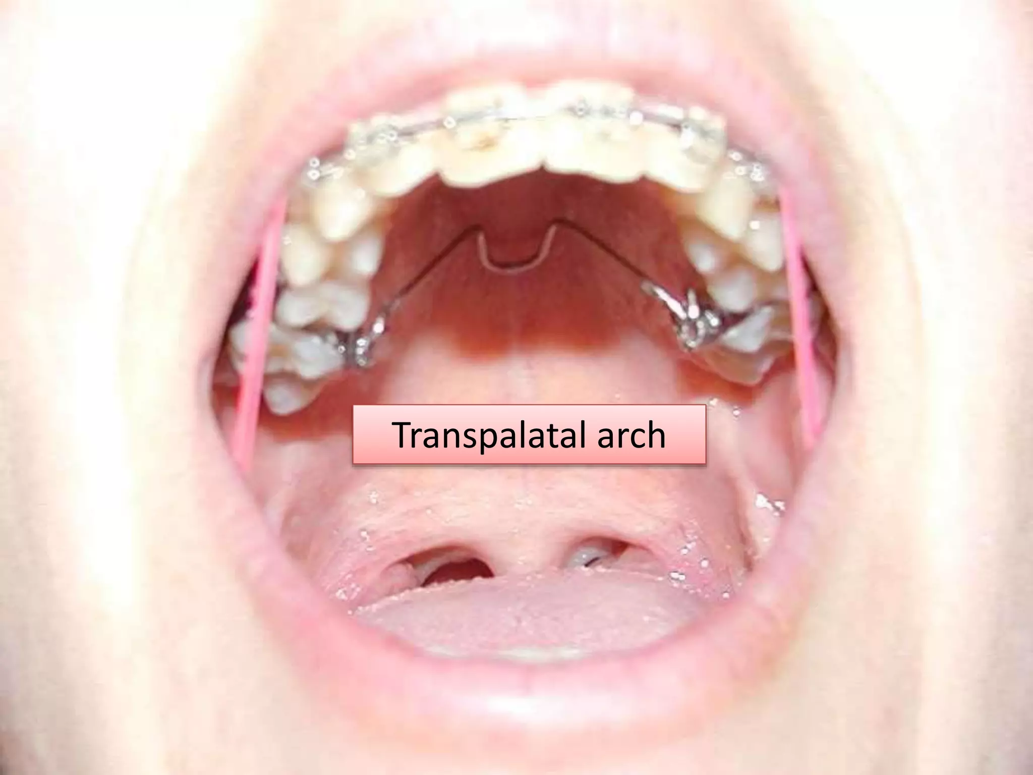 Hazards of swallowing orthodontic appliances | PPTX