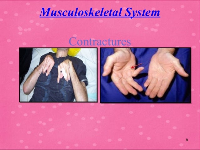 Immobility Definition