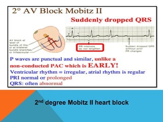 Heart Block with Nursing Management | PDF