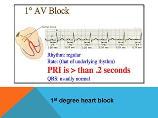 Heart Block with Nursing Management | PDF