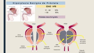 Hiperplasia Prostatica Benigna Clasificacion Pptx