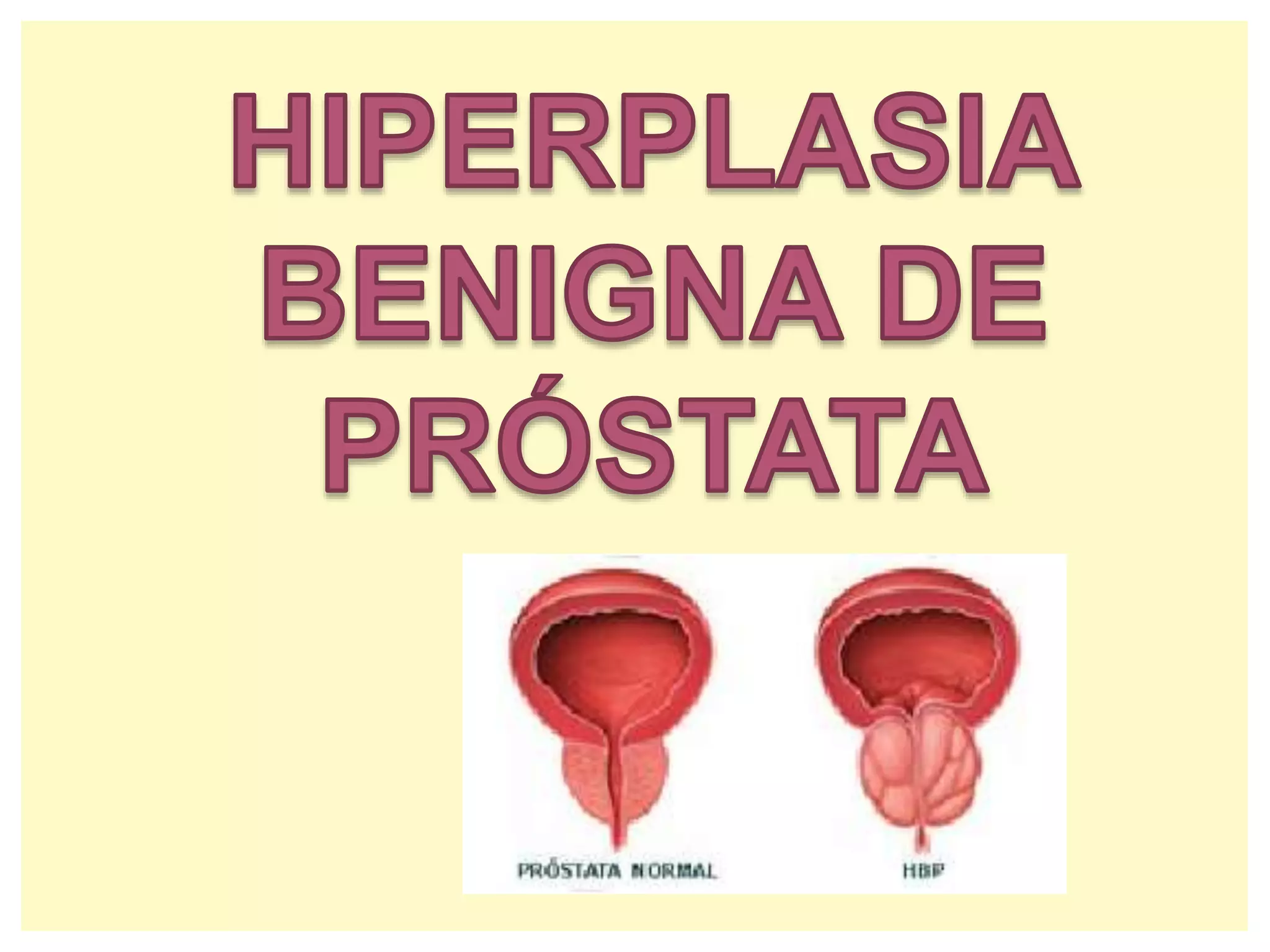 Hiperplasia Benigna de Próstata y su anatomía | PPT