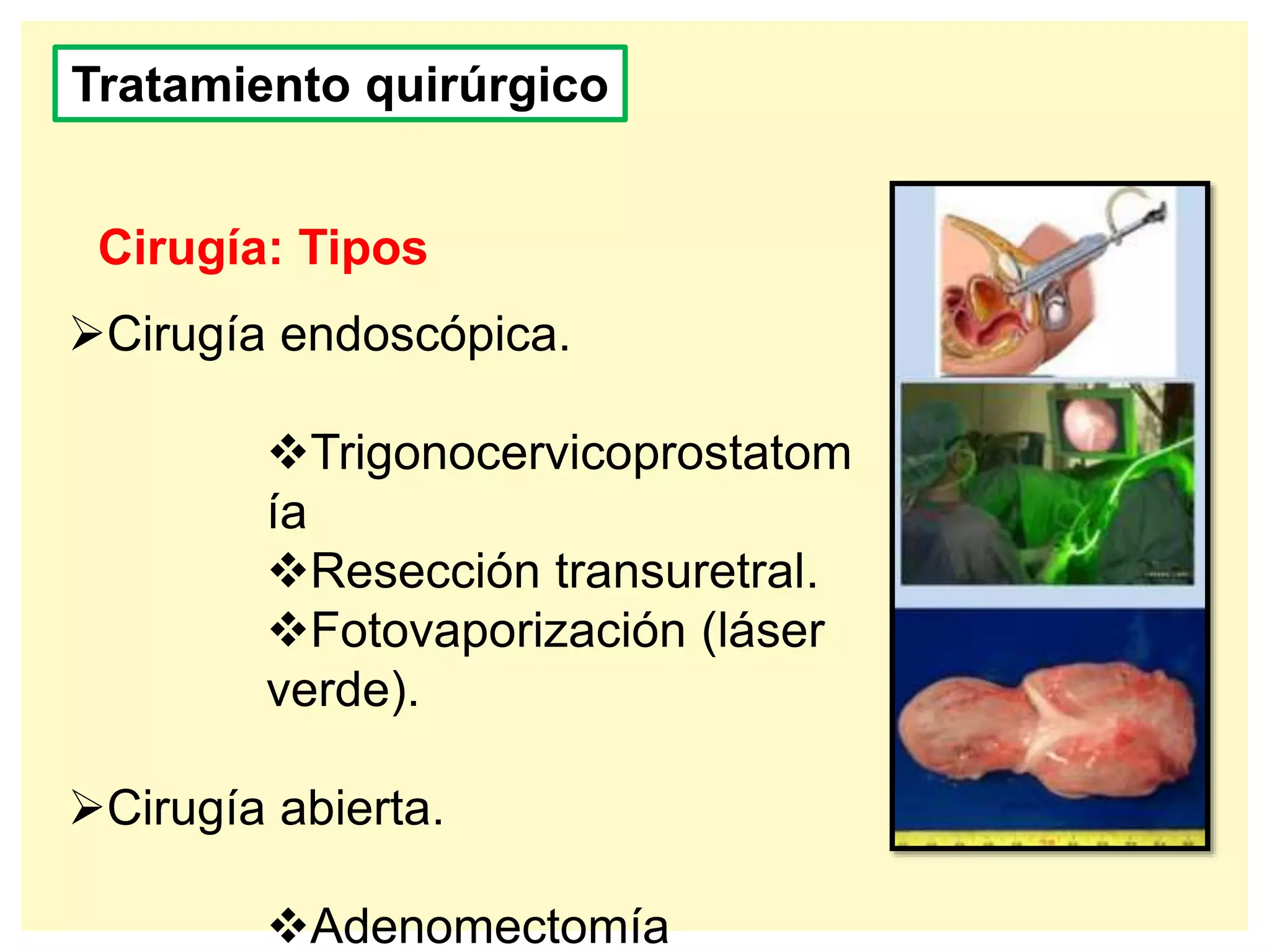 Hiperplasia Benigna de Próstata y su anatomía | PPT