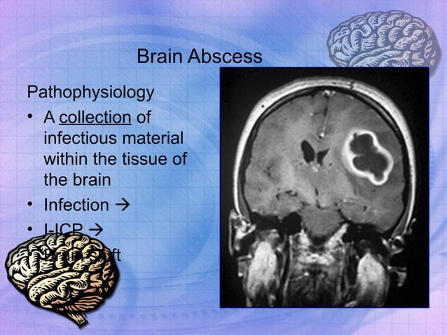 BRAIN ABSCESS | PPT