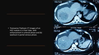 HCC CASE (1) (1).pptx