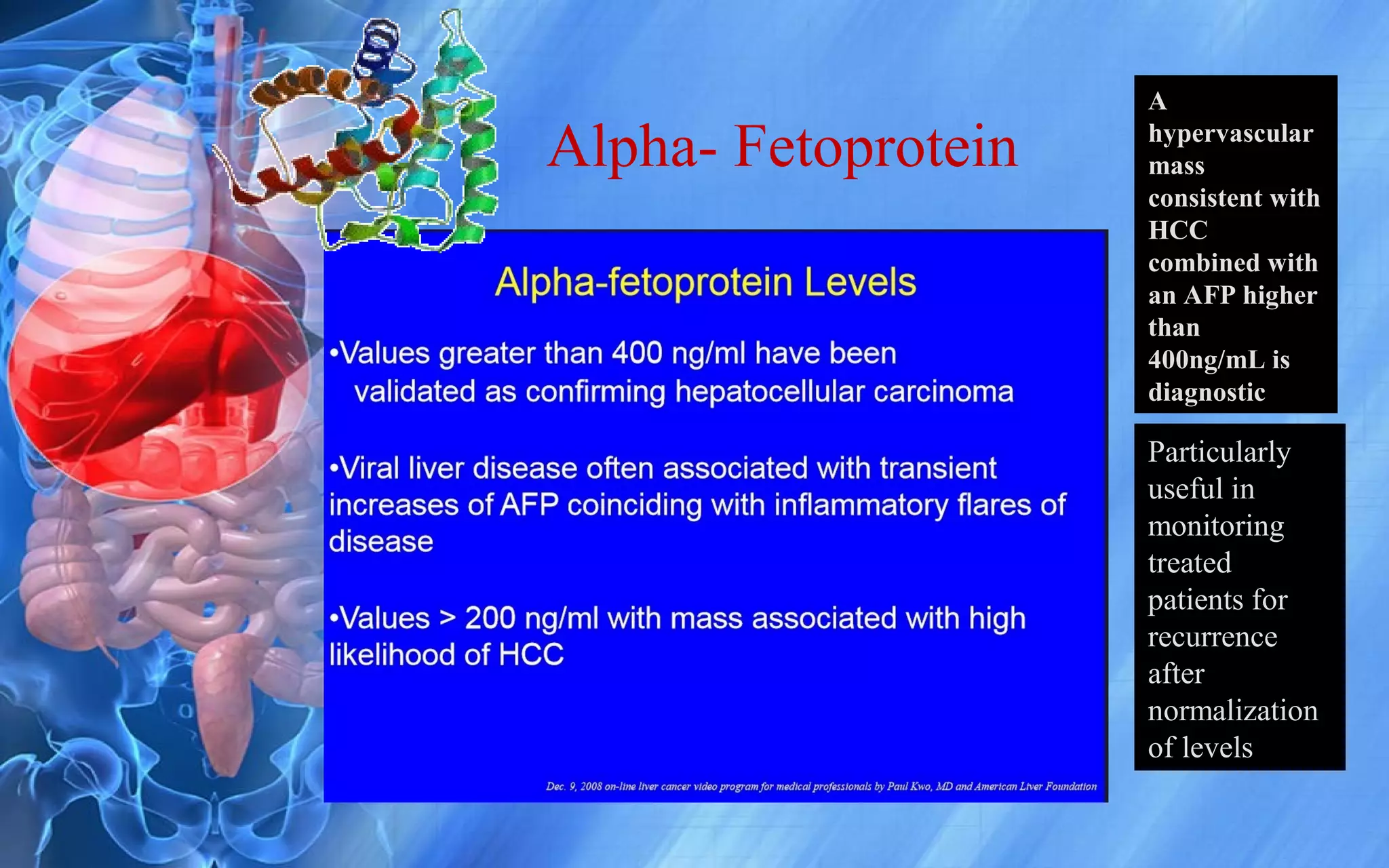 Hepatocellular Carcinoma- At a Glance | PPT