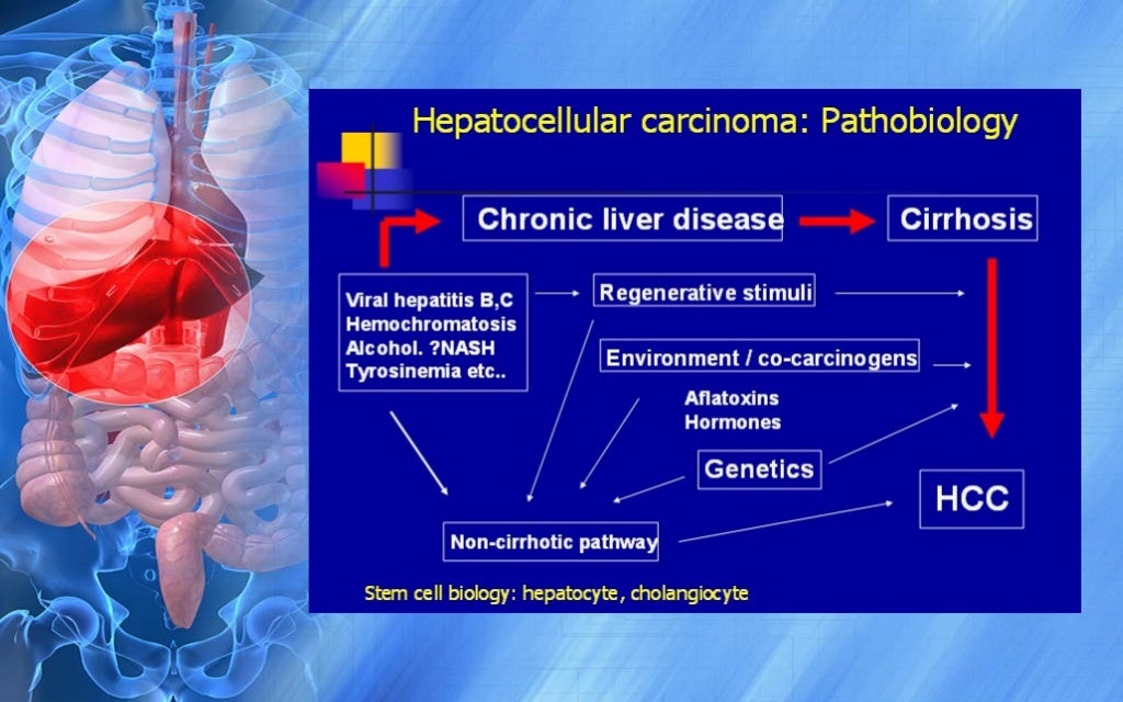 Hepatocellular Carcinoma- At a Glance