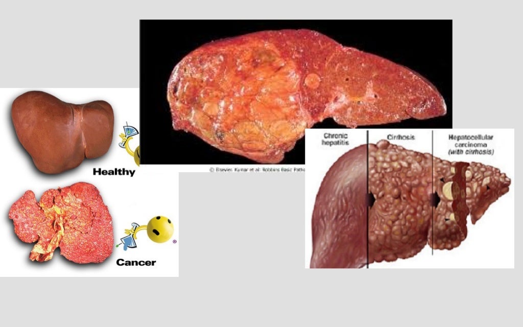 Hepatocellular Carcinoma- At a Glance