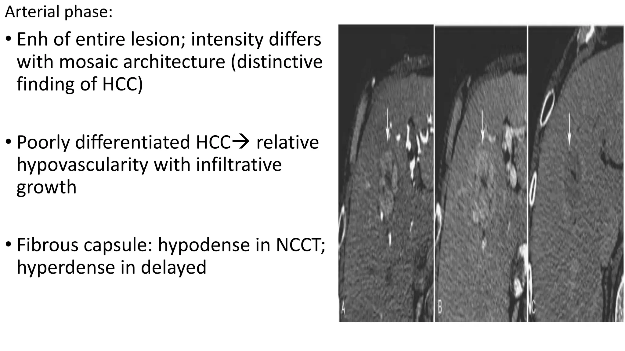 Hcc(hepatocellular carcinoma) | PPTX
