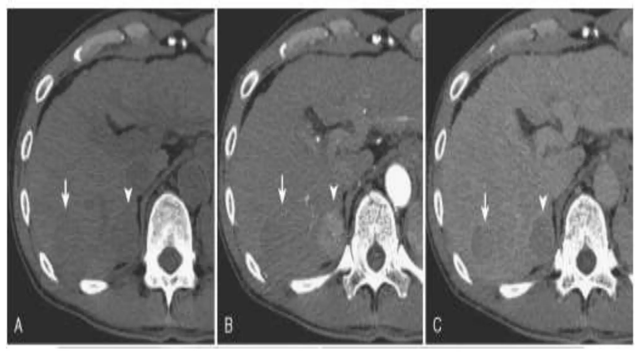 Hcc(hepatocellular carcinoma) | PPTX