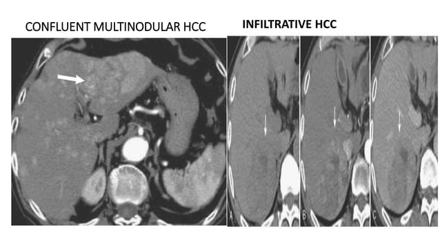 Hcc(hepatocellular carcinoma) | PPTX
