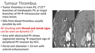 Hcc(hepatocellular carcinoma) | PPTX