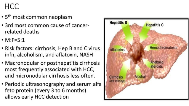 Hcc(hepatocellular carcinoma) | PPTX