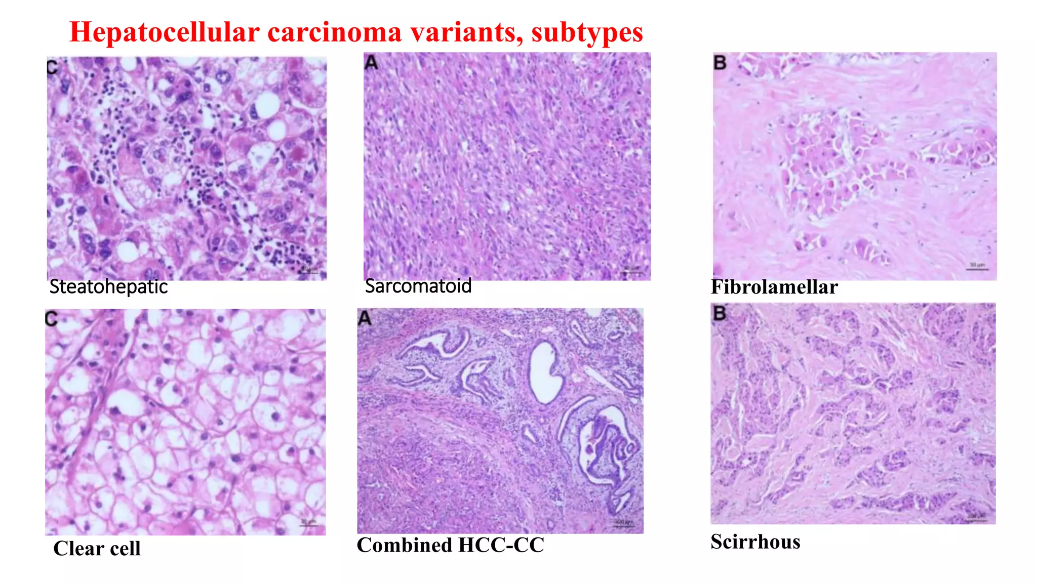 Hepatocellular carcinoma | PPTX