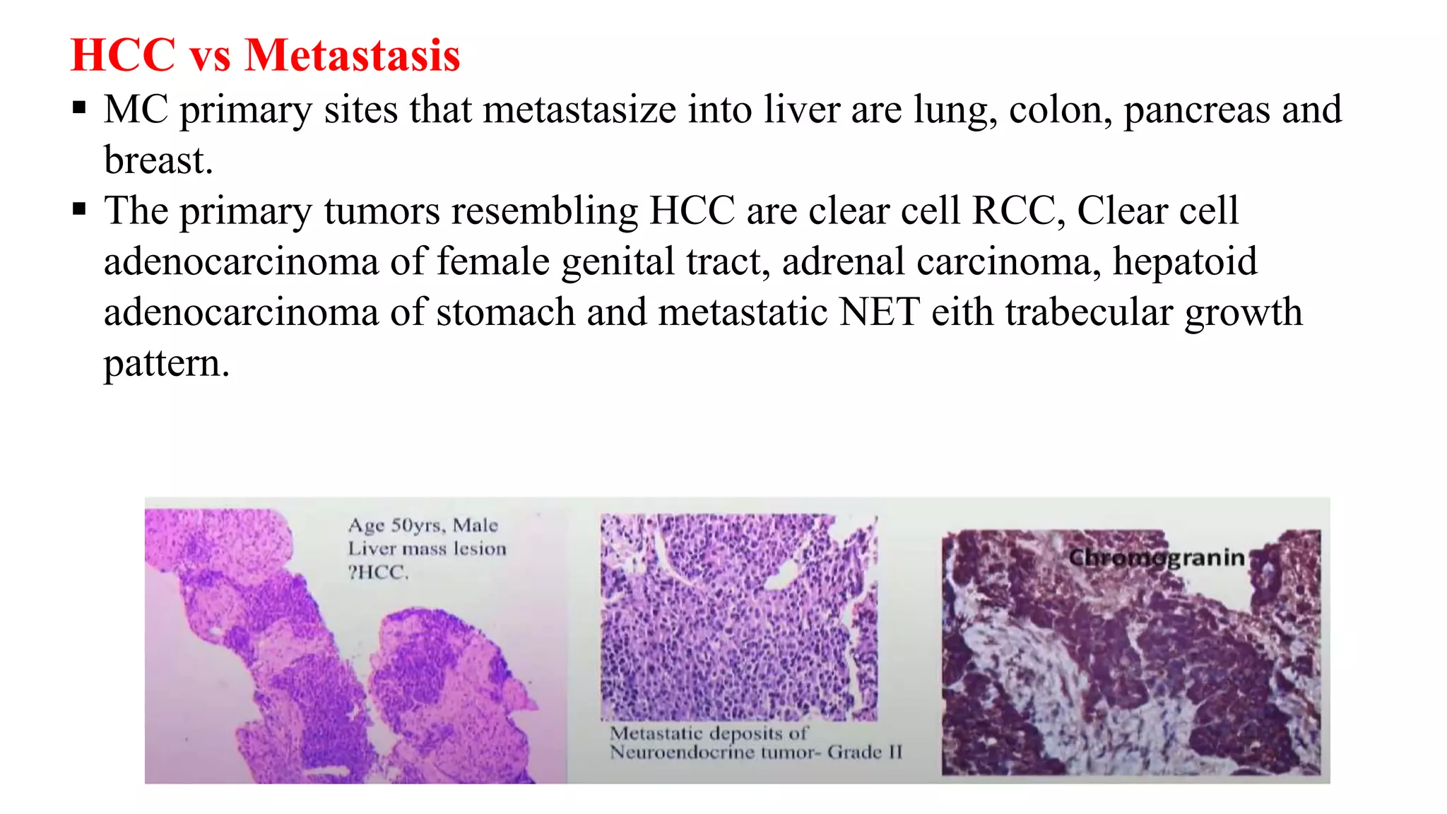 Hepatocellular carcinoma | PPTX