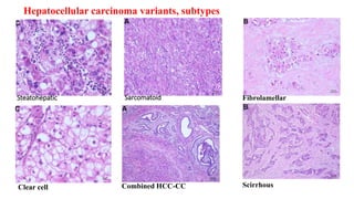 Hepatocellular carcinoma | PPTX
