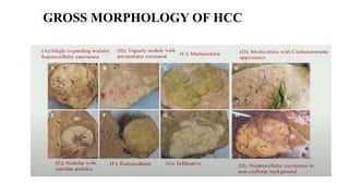Hepatocellular carcinoma | PPTX | Cancer | Diseases and Conditions