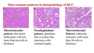 Hepatocellular carcinoma | PPTX | Cancer | Diseases and Conditions