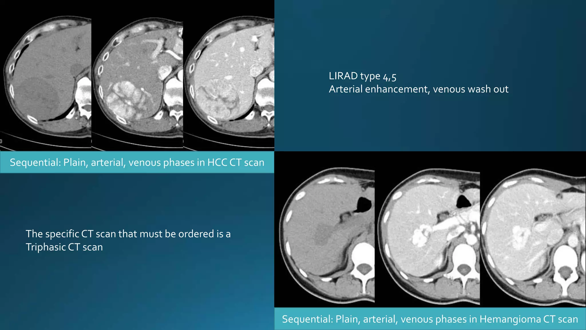 Basics of Hepatocellular cancer management for surgeons | PPTX ...