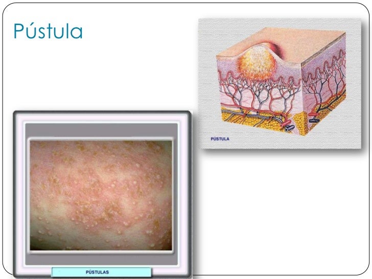 Historia Clínica Dermatológica y Lesiones Elementales