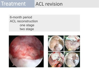 Septic arthritis after ACL reconstruction - Nhiễm trùng khớp sau tái ...