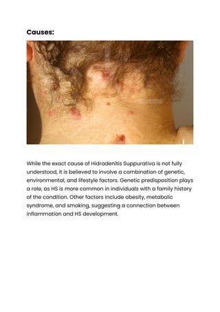 HC Hidradenitis Suppurativa | PDF
