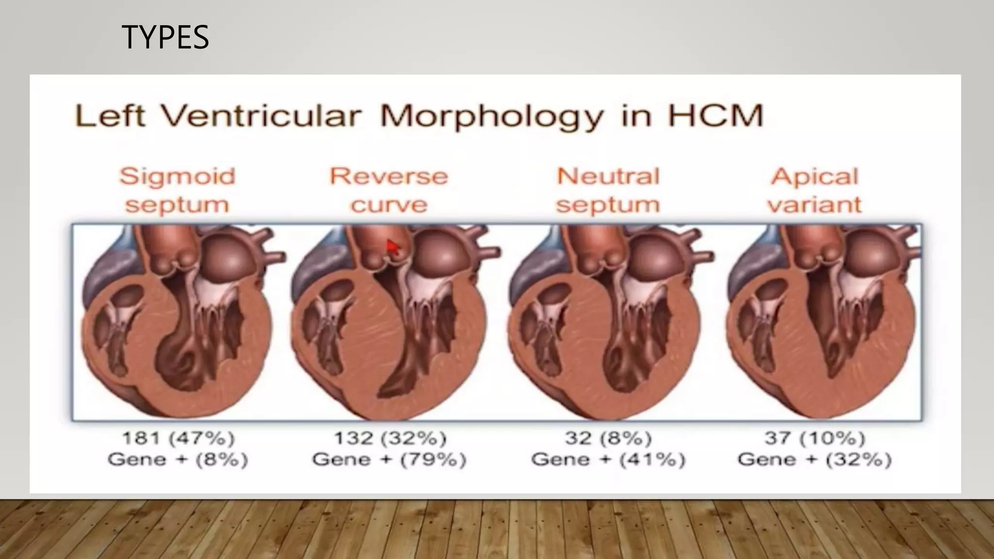 HOCM(hypertrophic obstructive cardiomyopathy) | PPTX