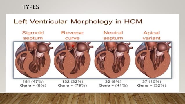 HOCM(hypertrophic obstructive cardiomyopathy) | PPTX | Heart and ...
