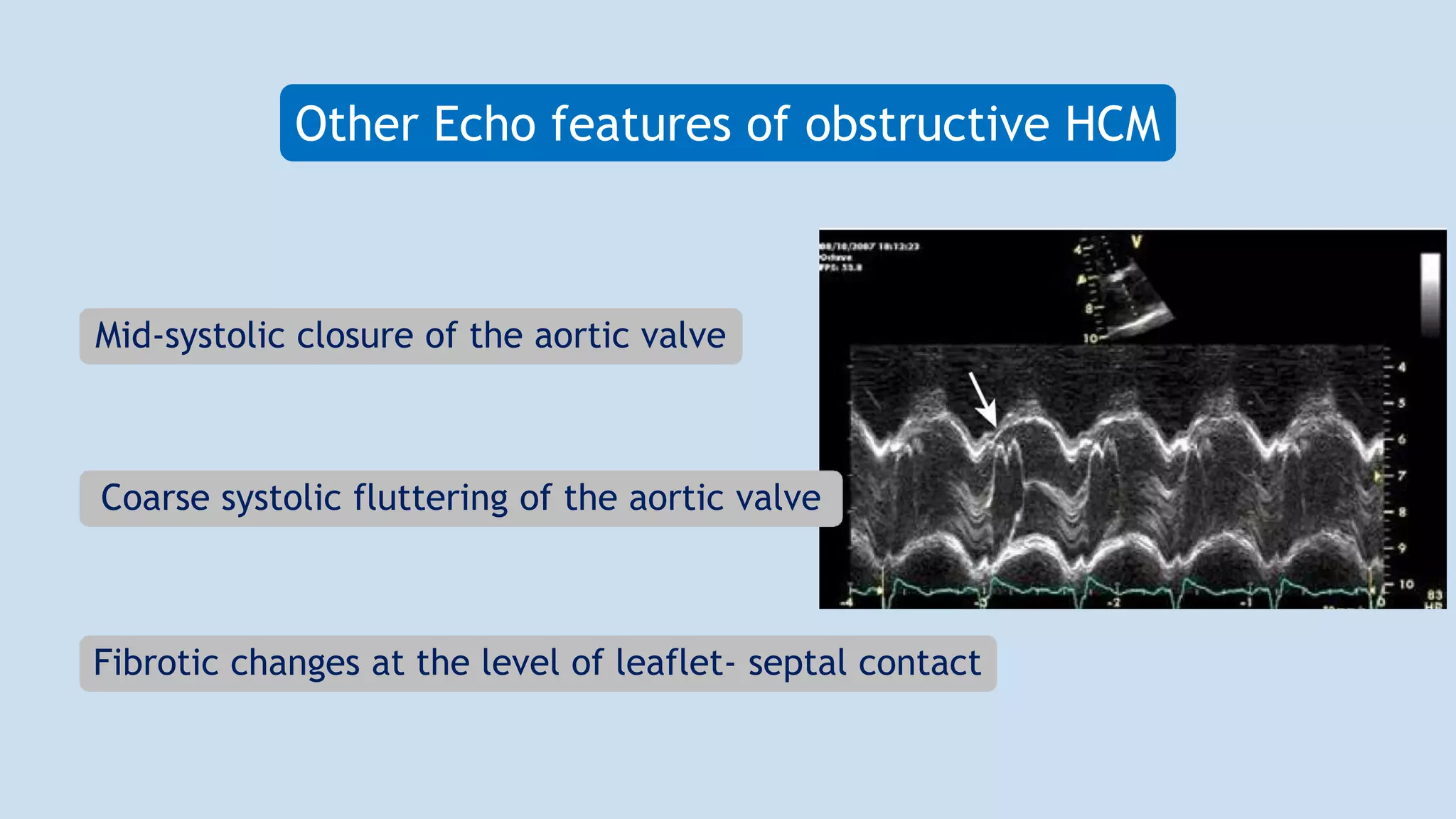 Echocardiographic Evaluation of Hypertrophic Cardiomyopathy | PPTX