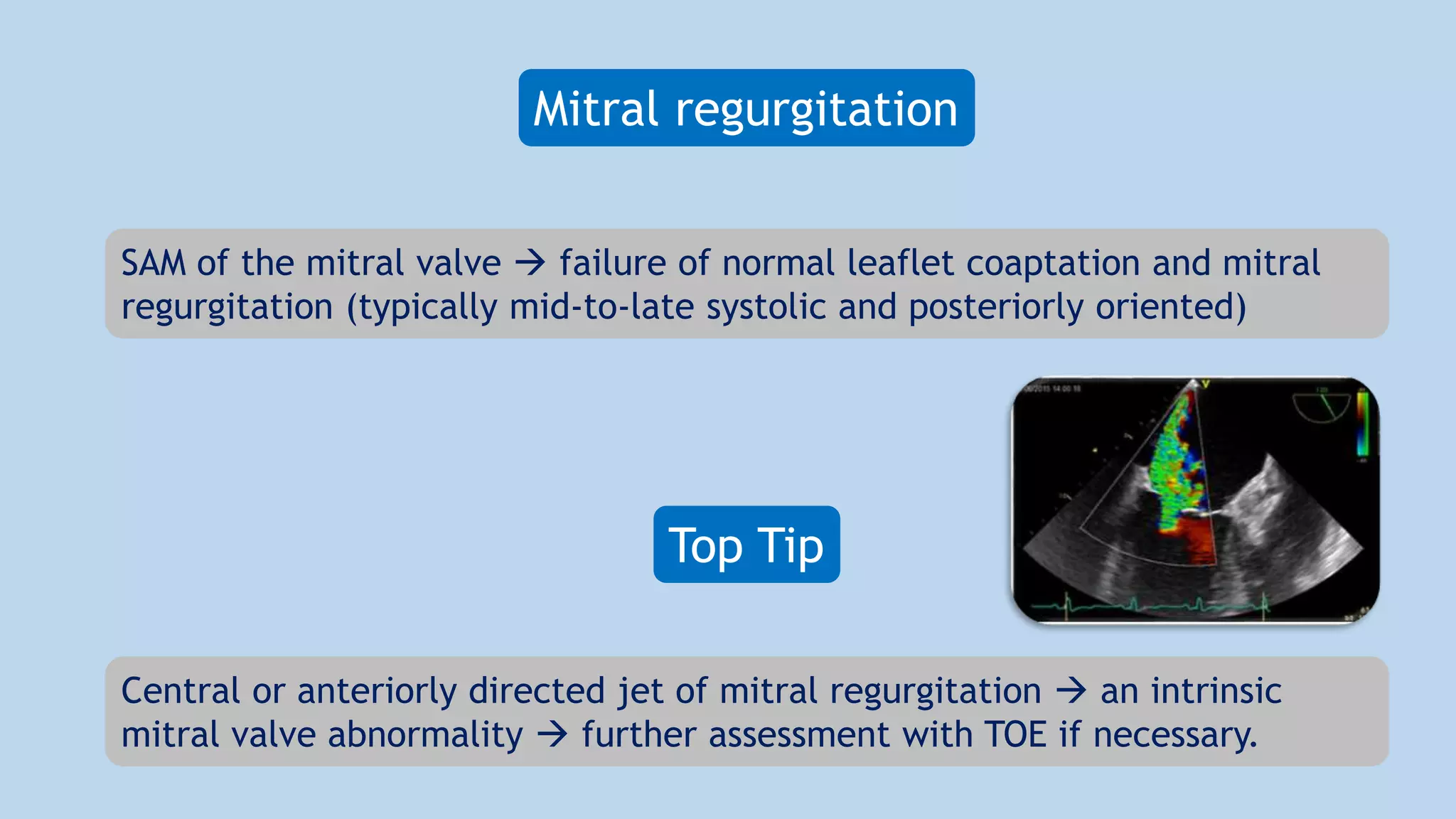 Echocardiographic Evaluation of Hypertrophic Cardiomyopathy | PPTX