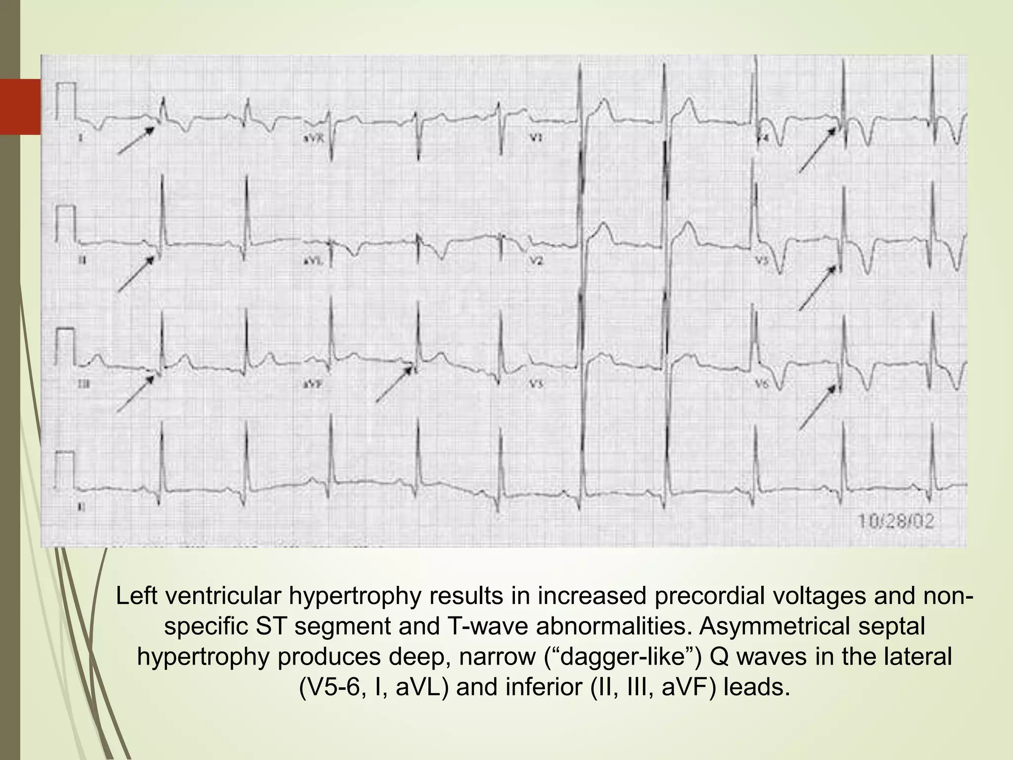 Hypertrophic cardiomyopathy | PPTX